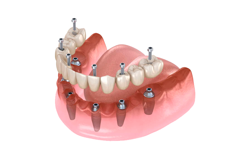Prótesis Dentales en Alcalá de Henares - Clínica Las Fronteras